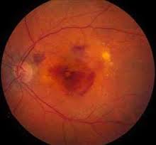 Pôle rétine médicale – ophtalmologiepyrenees.com