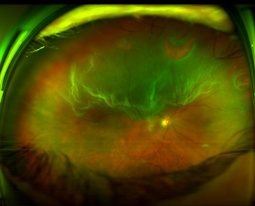 La chirurgie de la rétine - Centre Ophtalmologie Pyrénées